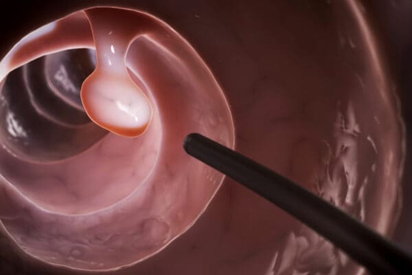 Colonoscopy: examination of the colon - myDr.com.au