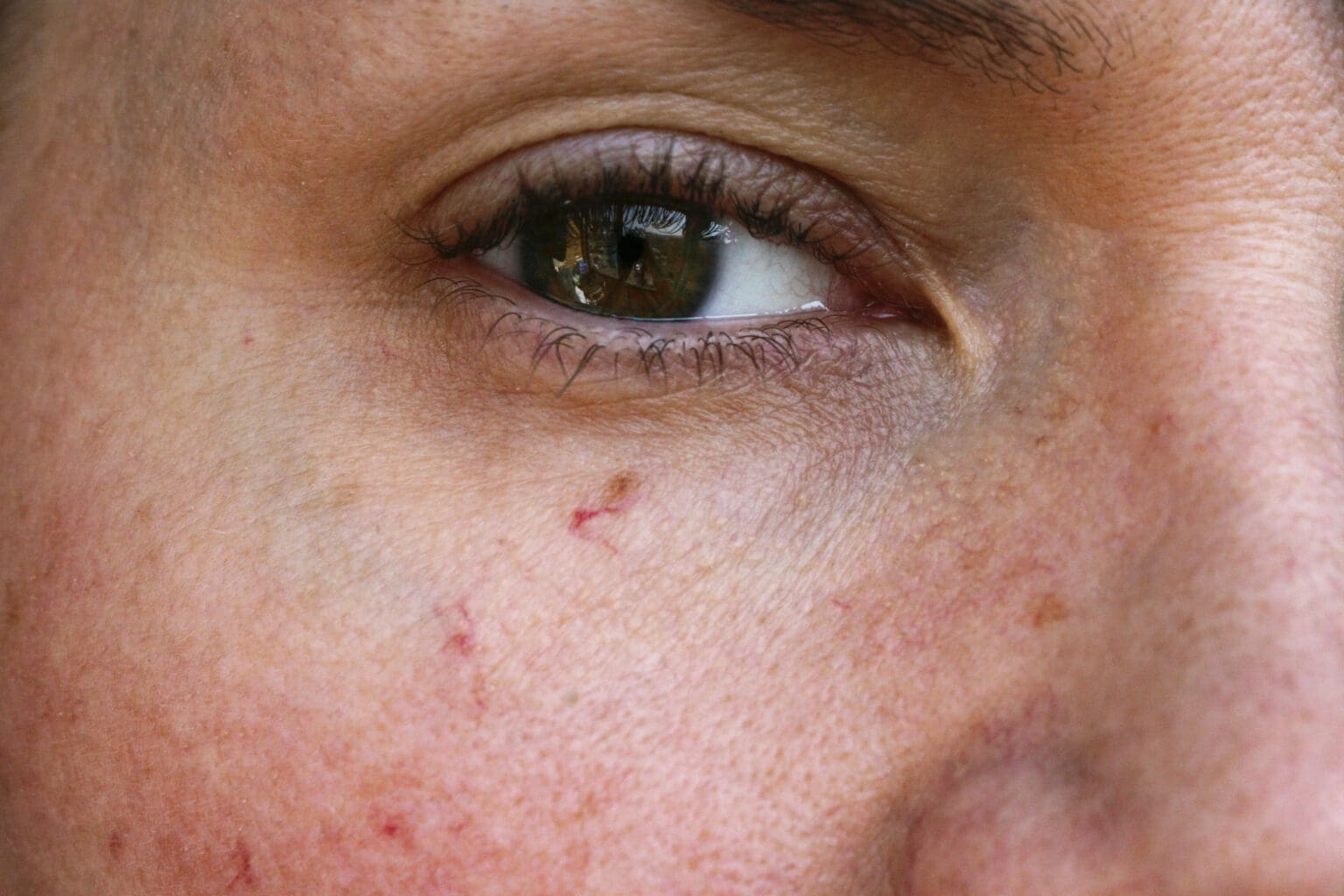 What is Hereditary Haemorrhagic Telangiectasia? - myDr.com.au