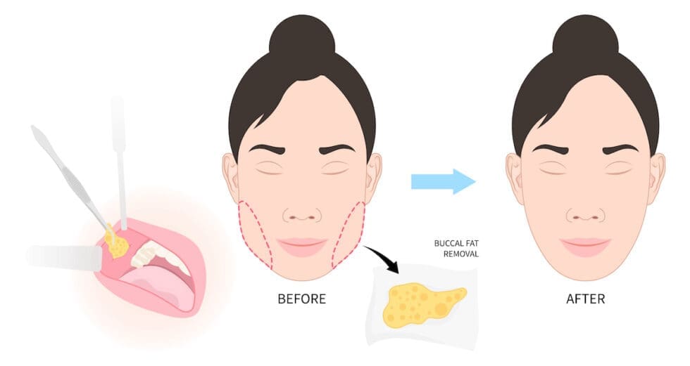 Buccal fat removal: cost, process, recovery, risks - myDr.com.au